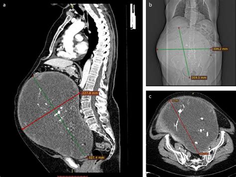 Case Of A Huge Uterine Mass Weighing 11000 G Computed Tomography