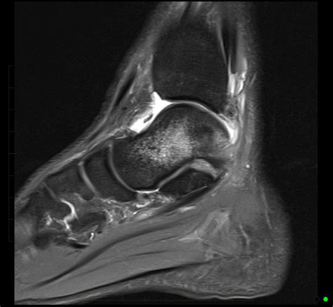 Mri Ankle Anterior Talofibular Ligament Rupture 2 Mri At Melbourne Radiology Clinic