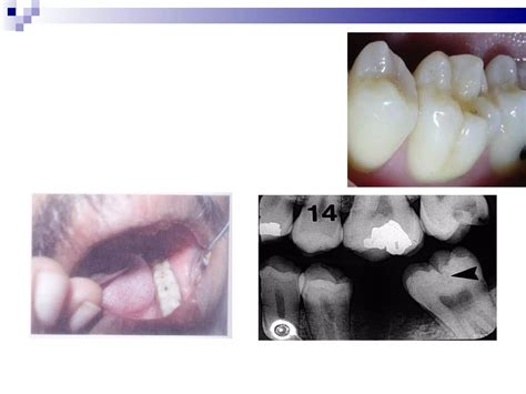 Clinical Features And Histopathology Of Dental Caries Ppt