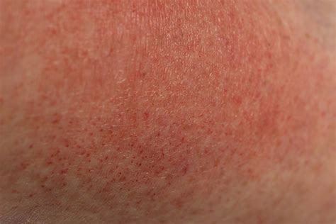 Heat Rash Sun Rash Whats The Difference Osf Healthcare
