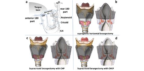 Partial Laryngectomy