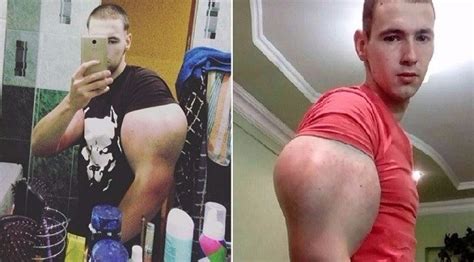 يحصل على عضلات باباي بحقن نفسه بالزيت موقع 24