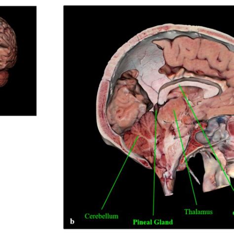 Pineal Teratoma Mri Sagittal T1 Image A Axial T1 B And Sagittal