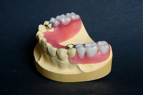 Partial Flex Trendgold