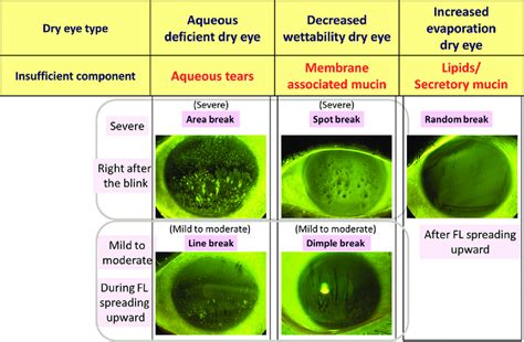 tear film oriented diagnosis tfod the fluorescein breakup patterns