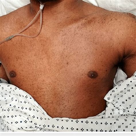 Maculopapular Rash Present Two Days After The Administration Of