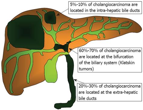 Cholangiocarcinoma Type