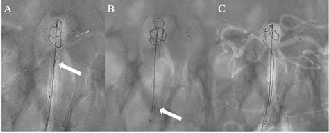 Intraoperative X Ray Image The Arrow Shows The Tip Of Mc For The First Download Scientific