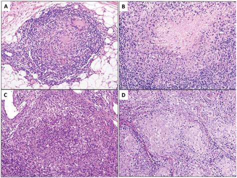 Caseating Granulomas In Cutaneous Leishmaniasis Plos Neglected Tropical Diseases