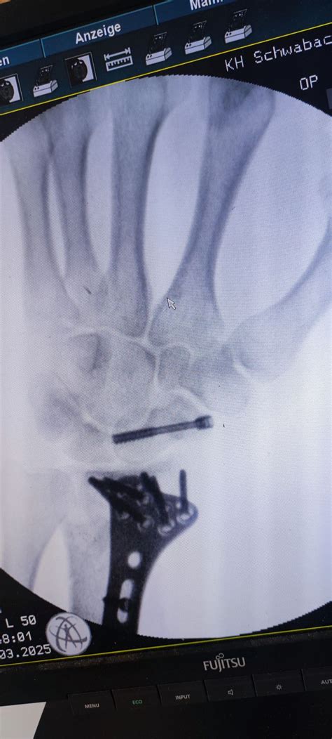 Distal Radius Fracture And Scaphoid Fracture Ipsilateral Walid Hussein
