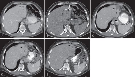 Interventional Imaging In The Oncologic Patient Clinical Tree