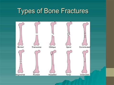 Vsr610 Ppt Fracture Pptx Classification Of Fractures Pptx
