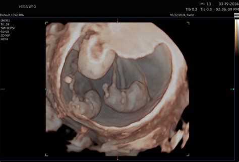 Dichorionic Twin Charts Gefoghealthfoundation