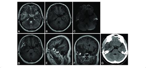 A Axial T2 Weighted Imaging Showed Multiple Heterogeneous Download Scientific Diagram