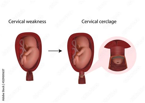 Cervical Weakness Treatment Cervical Cerclage Fetus In Uterus Womb