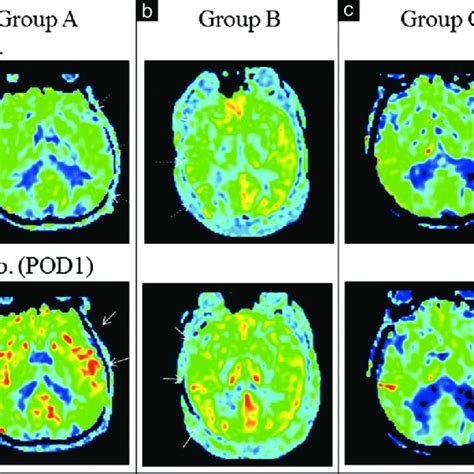 Ct Scan Of The Brain Axial Sequence Shows An Area Of Hyperdensity In Download Scientific