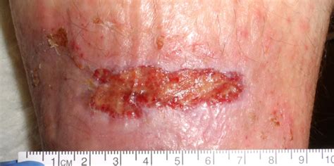The Many Faces Of Pyoderma Grangrenosum A Leg Ulcer Present For A Year Caroline Fife M D