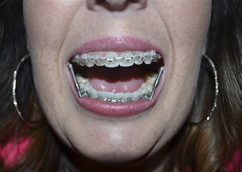 Braces Forsus Appliance At Violet Charette Blog