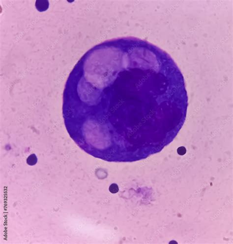 Ascitic Fluid Cytology Leishman Stain Smear Show Lymphocytes Polymorphs Cells Abnormal Cells