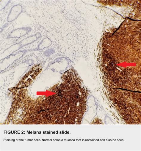 Figure 1 From Malignant Melanoma Metastasizes To Colonic Polyp