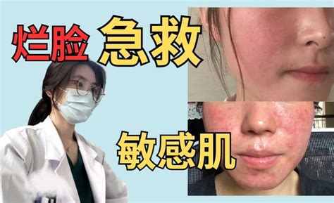 皮肤动不动就敏感发痒泛红过敏还有救吗？敏感肌怎么修复皮肤屏障？【三甲医生】总结过往案例，1招教你【烂脸急救】！轻松安抚皮肤情绪、一键修复屏障肌
