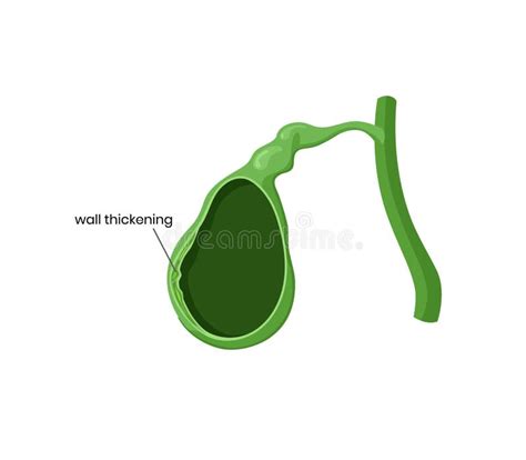 Illustration Of The Gallbladder Wall Thickening Vector Immage Of The