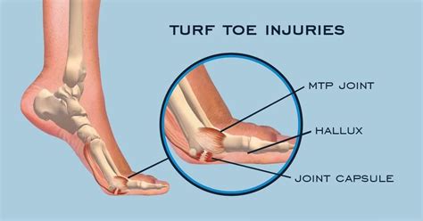 The Best Turf Toe Exercises Artofit