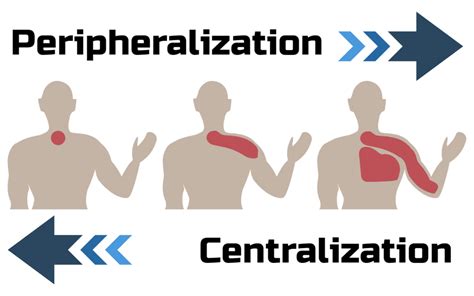 Centralization Vs Peripheralization — Physiotherapy London Ontario