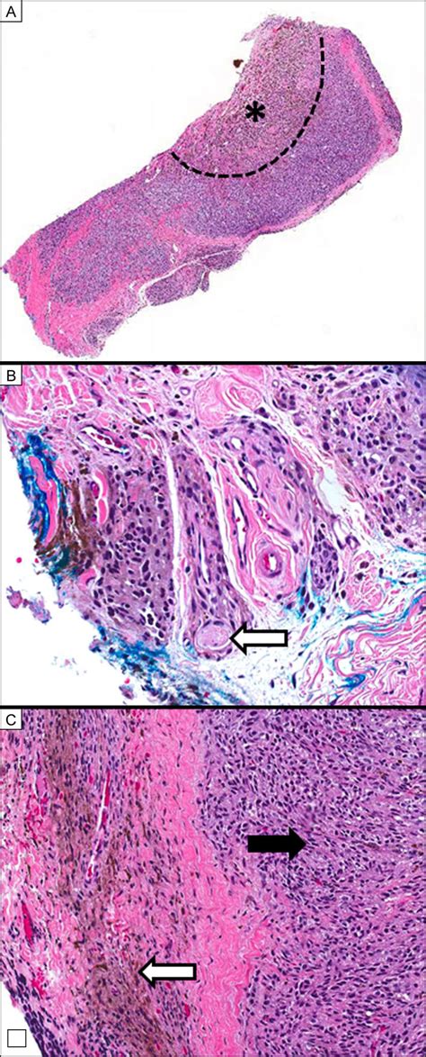 A Histologic Sections Of Resection Specimen From Patient 3 Reveal A
