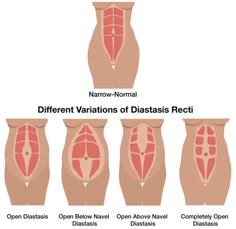 The Truths Of Diastasis Recti Divarication Trainerize Me