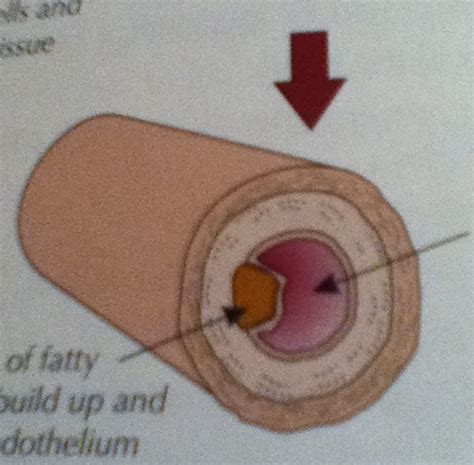 How Atheroma Plaques Lead To Cardiovascular A2 Biology