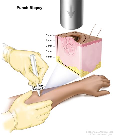Skin Cancer Treatment Nci