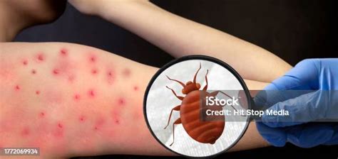 무당 벌레가 인체에 물린다 벌레 물림으로 인한 피부의 가려움증 붉은 반점 Cimex Lectularius는 국내 피를 빨아 먹는