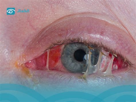 Eye Infection Treatment Causes And Symptoms