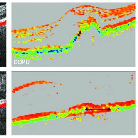 Polarization Sensitive Optical Coherence Tomography Ps Oct A