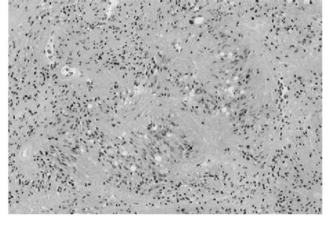 Photomicrograph Of The Tumor Showing Elongated Bipolar Spindle Cells
