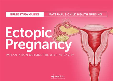 Ectopic Pregnancy Nursing Care And Management