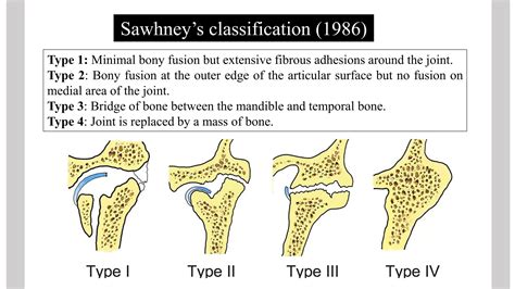 Tmj Ankylosis Of The Jaw And Its Clinical Significancies Pptx