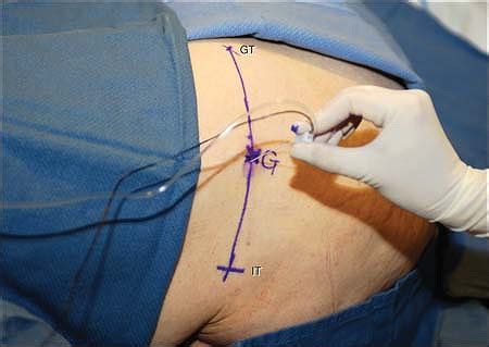 Sciatic Nerve Blocks TeachMe Orthopedics