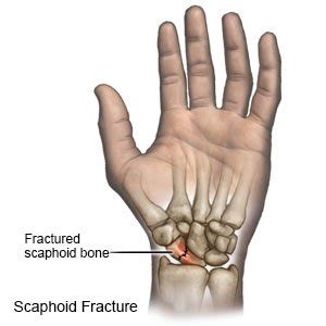 Scaphoid Fracture What You Need To Know