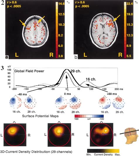 Figure 2 From Non Invasive Epileptic Focus Localization Using Eeg