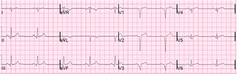 Is This New Lad Occlusion With St Elevation Superimposed On Old Qs Wave Mi Dr Smiths Ecg Blog