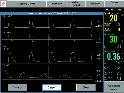 FREMITUS Quantifying Patient Ventilator Asynchrony
