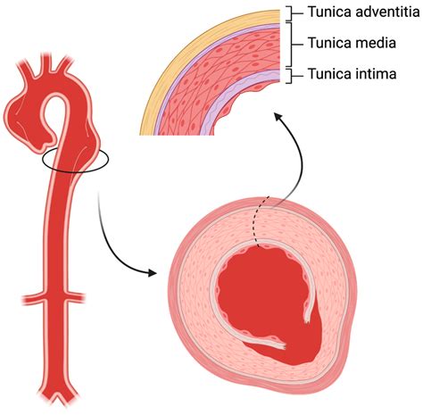 Debakey And Stanford Aortic Dissection Classification Download