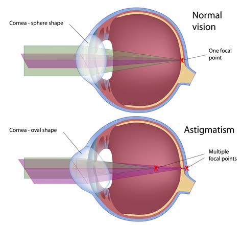 Types Of Astigmatism With Examples