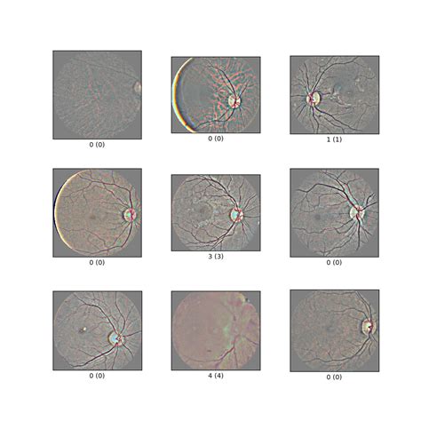 Diabetic Retinopathy Classification Dataset And Pre Trained Model By