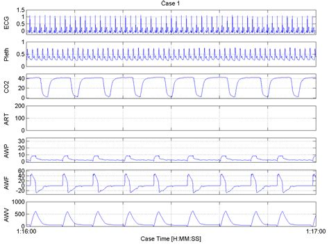 Case 1 Waveform Plots 60 Second Plots