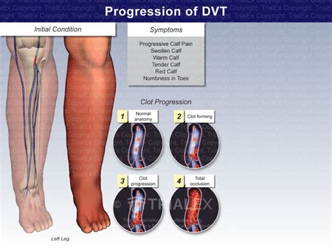 Progression Of Dvt Trialquest Inc