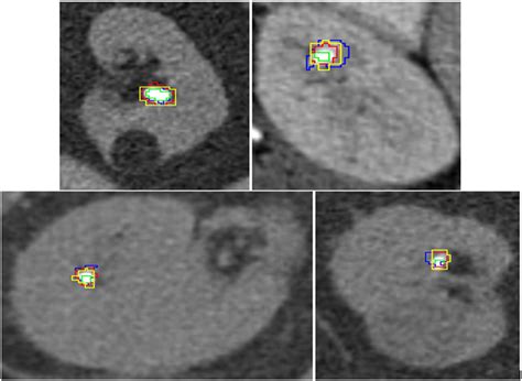Automated Machine Learning Segmentation And Measurement Of Urinary Stones On Ct Scan Pmc