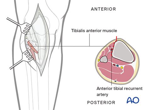 Anterolateral Approach To The Proximal Tibia